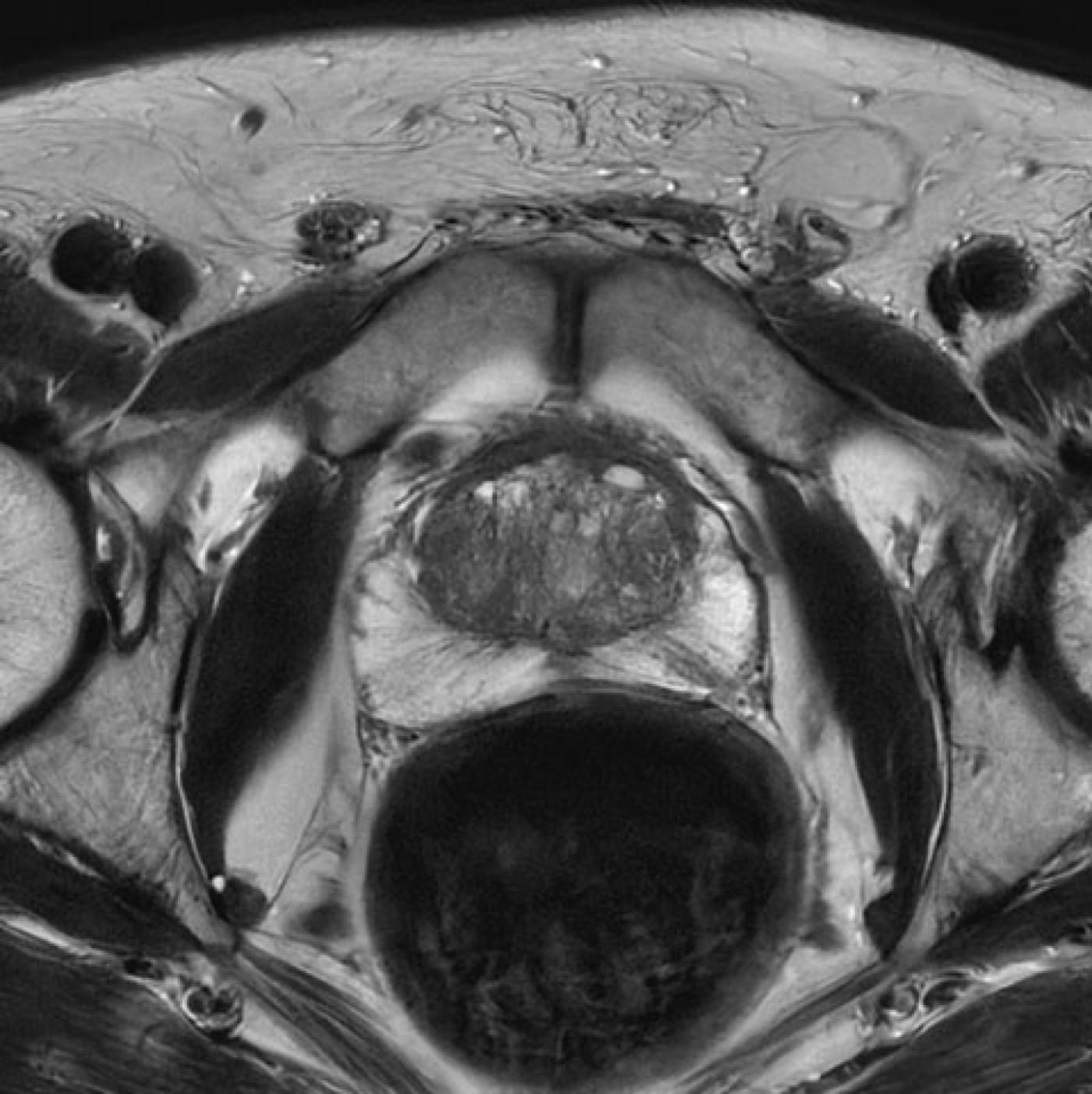 MRT der Prostata | diagnostikzentrum Gießen